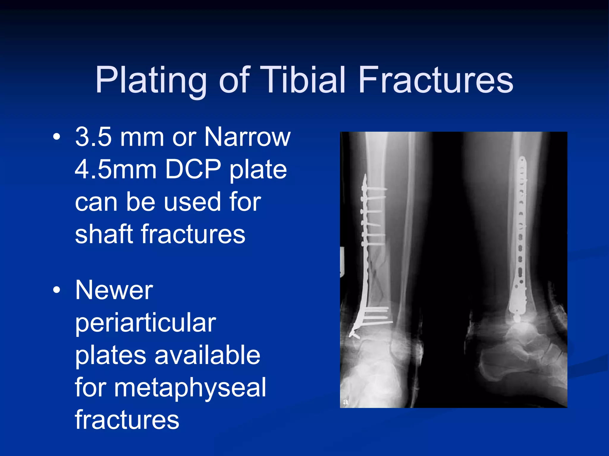 Fracture of Tibia,ankle and foot.ppt