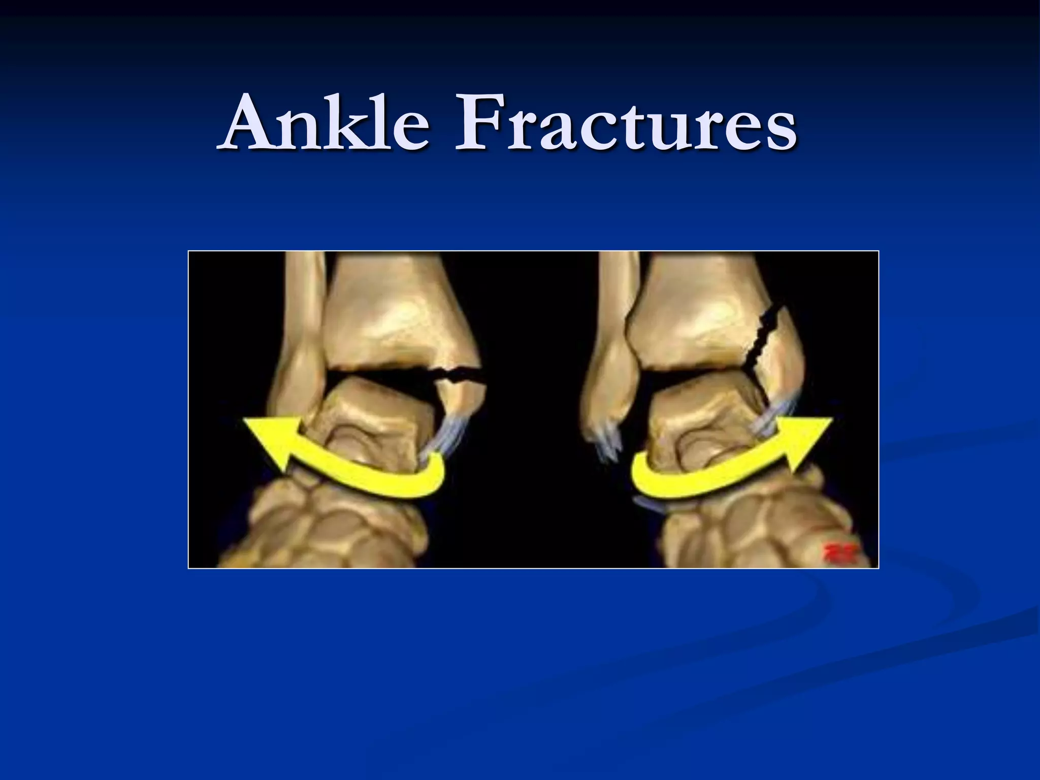Fracture of Tibia,ankle and foot.ppt