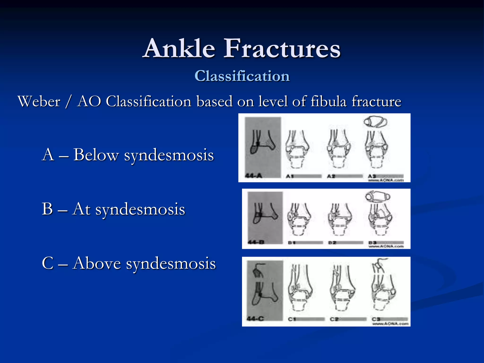 Fracture of Tibia,ankle and foot.ppt