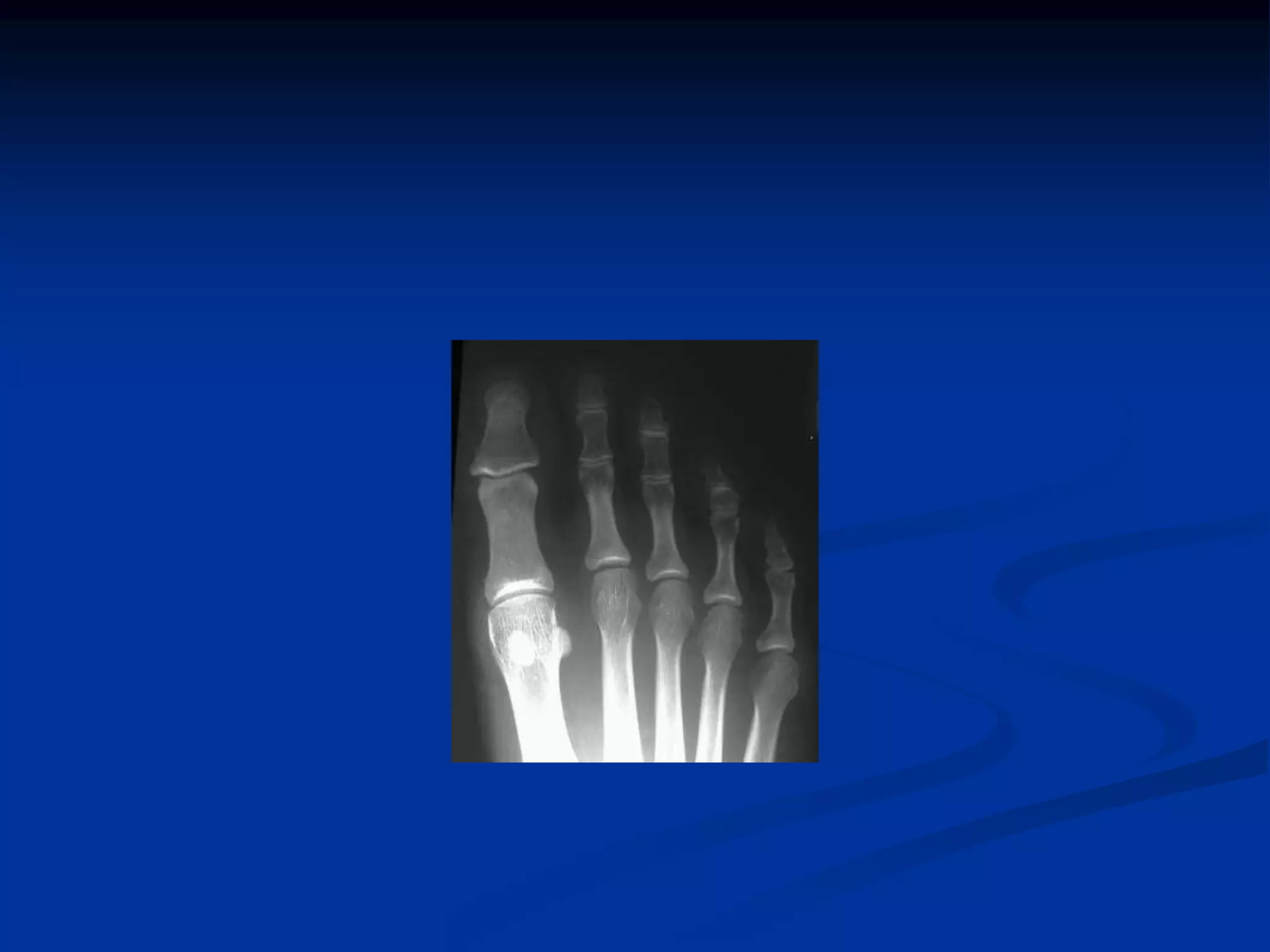 Fracture of Tibia,ankle and foot.ppt