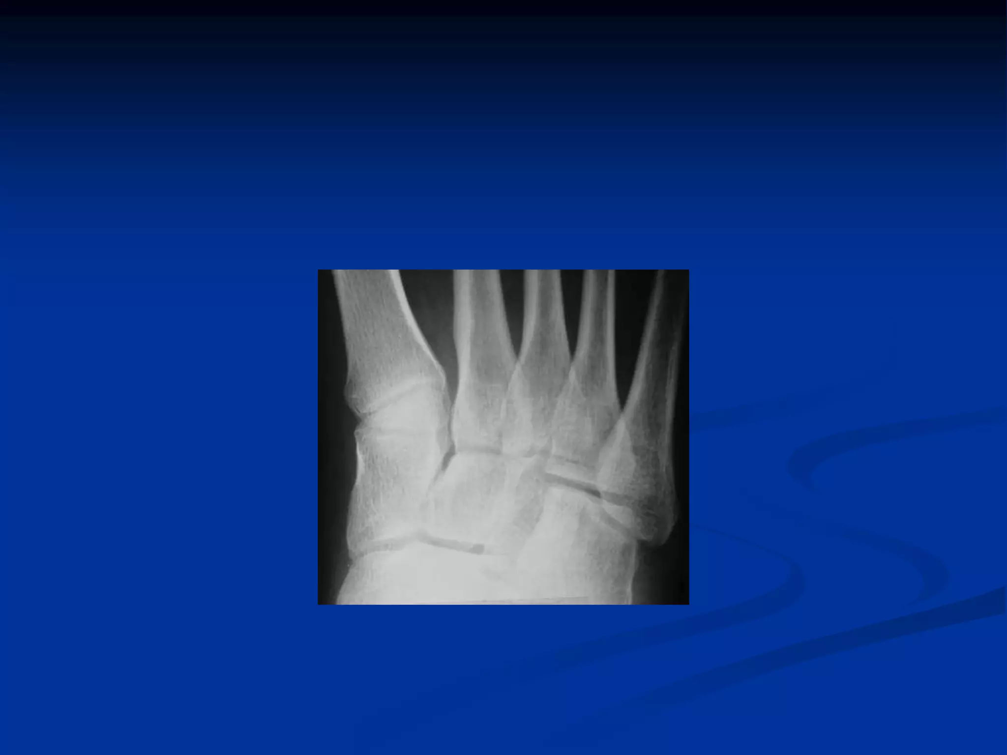 Fracture of Tibia,ankle and foot.ppt