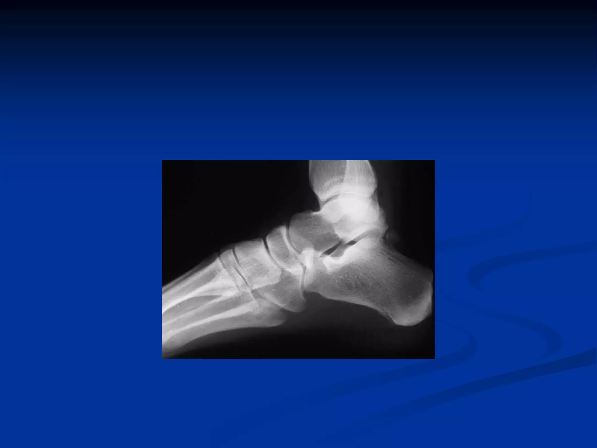 Fracture of Tibia,ankle and foot.ppt