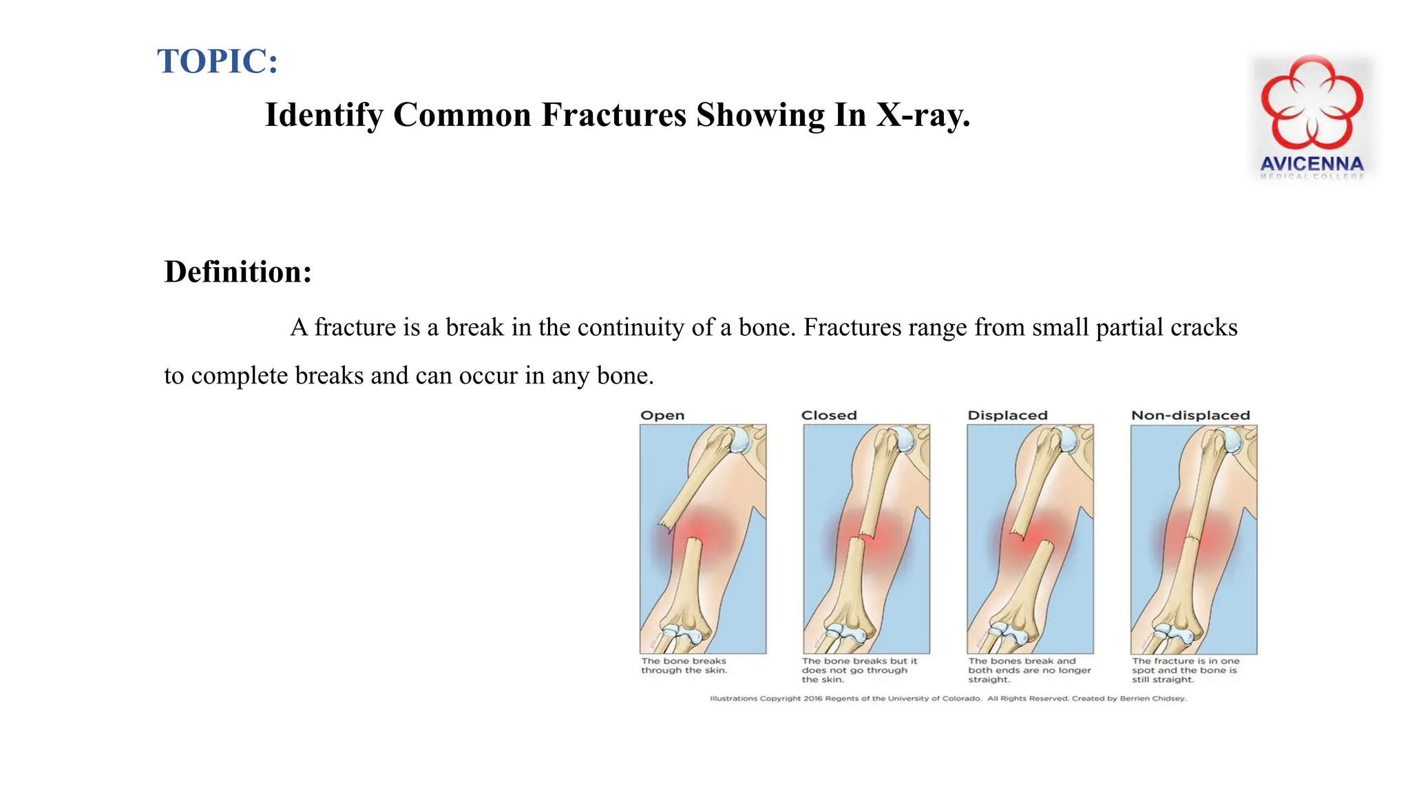 Fracture on X-Ray.examination of cxr pptx | PPTX