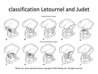 Fracture of Pelvis and Spine | PPTX