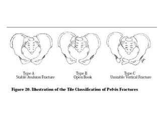 Fracture of Pelvis and Spine | PPTX
