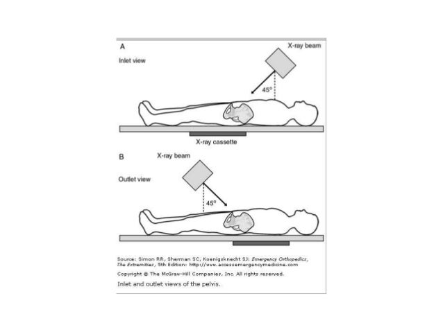 Fracture of Pelvis and Spine