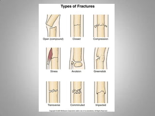 FRACTURE CHAPTER 4 PRESENTATION | PPT
