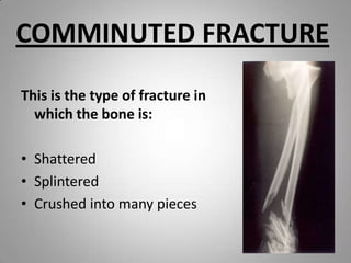 FRACTURE CHAPTER 4 PRESENTATION | PPT