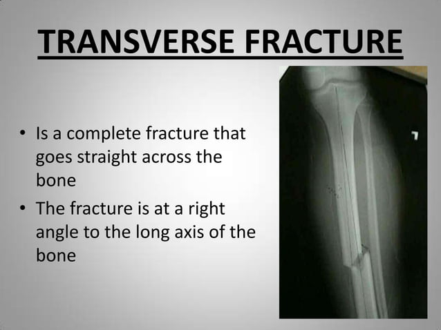 FRACTURE CHAPTER 4 PRESENTATION | PPT