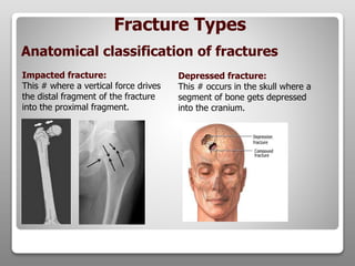 fracture pp.ppt | First Aid | Injuries