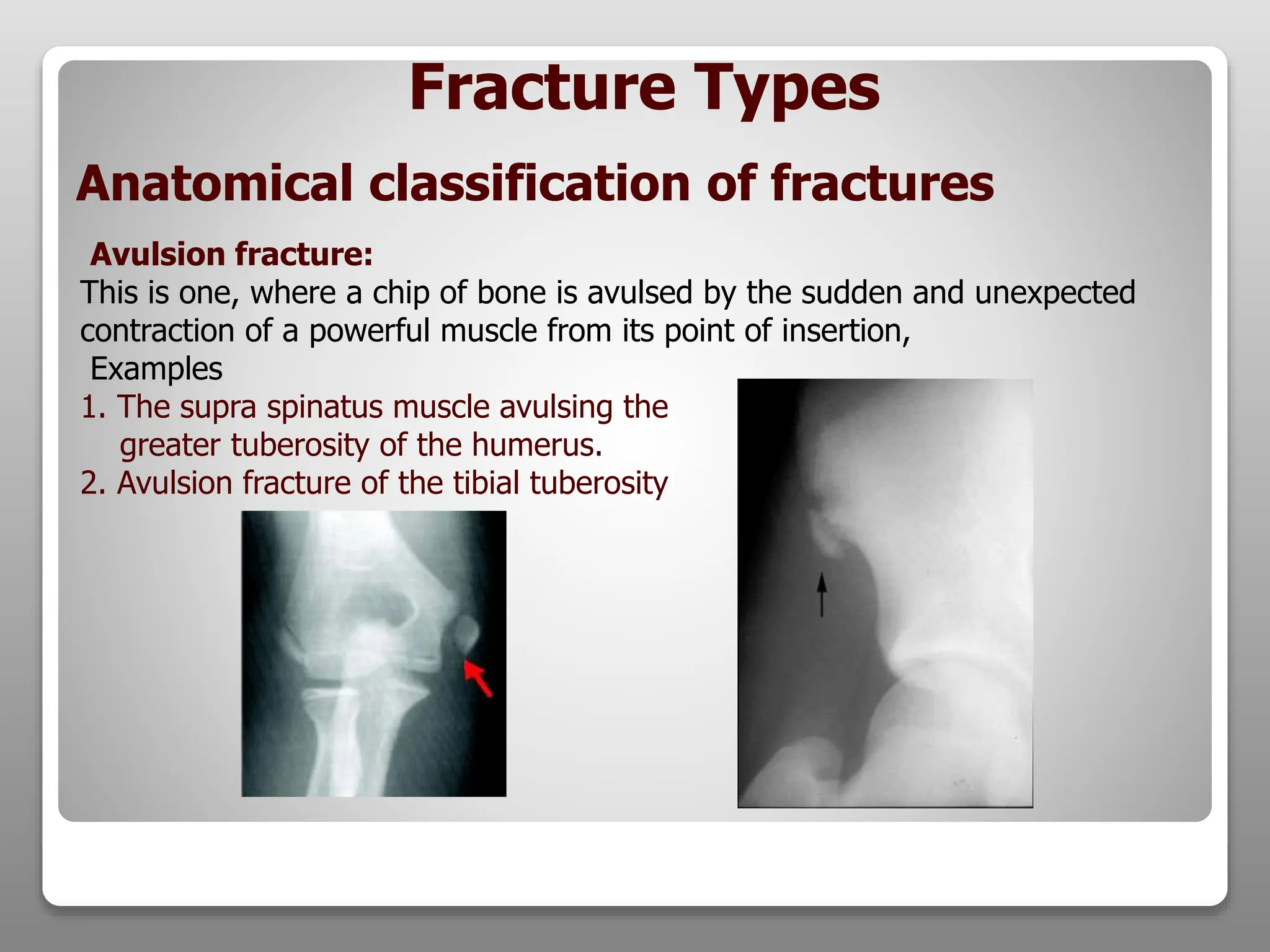 fracture pp 2.ppt medical surgical nursing | PPT