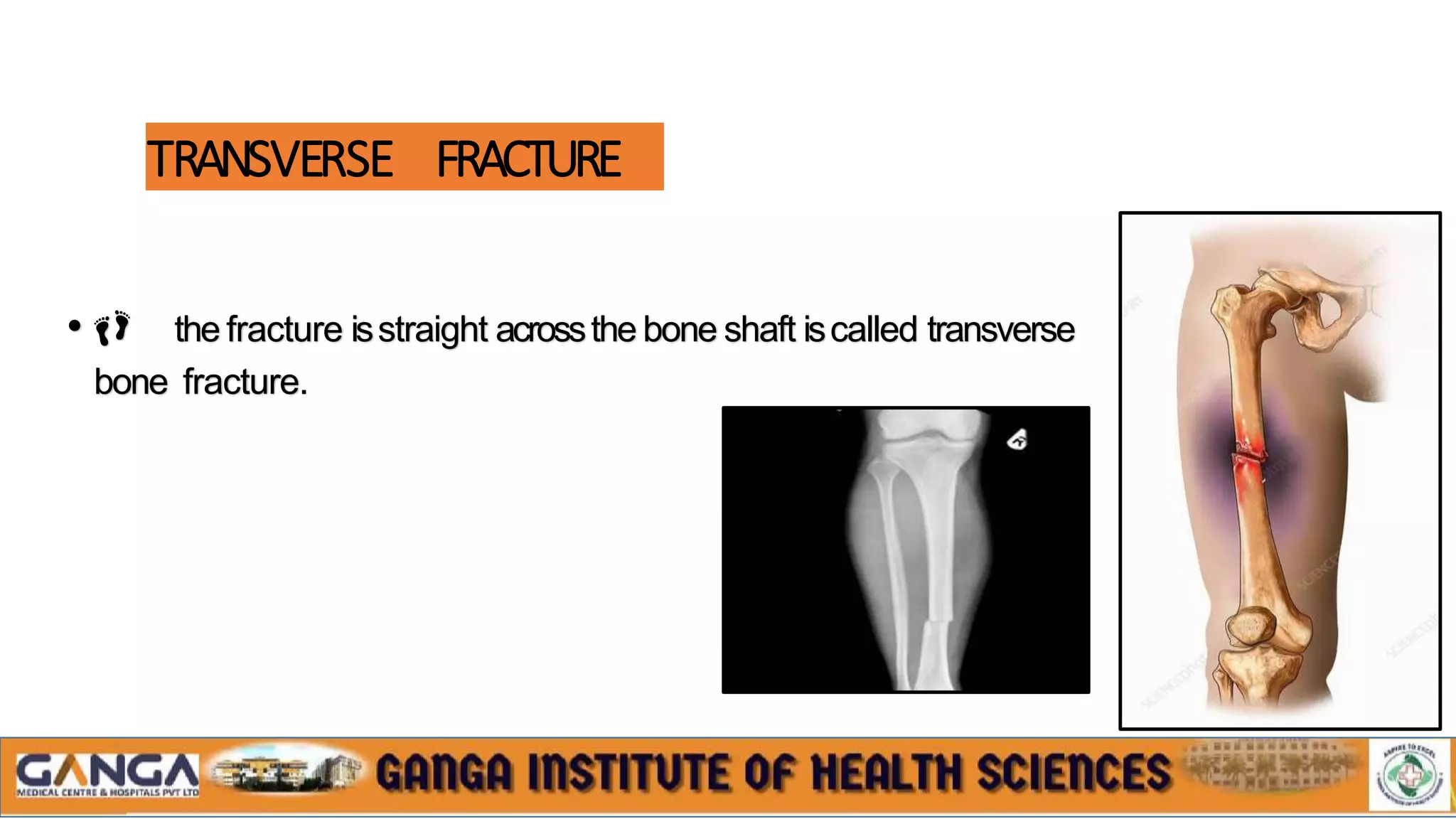 fracture ppt.pptx