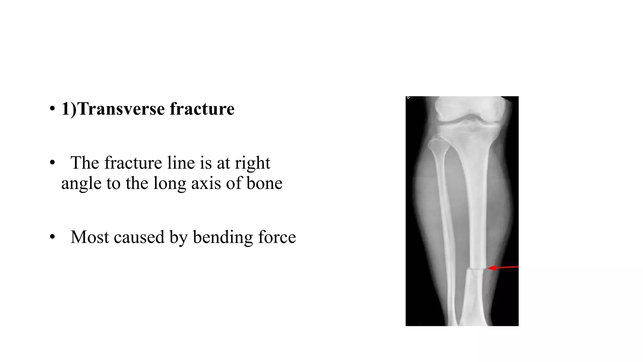 FRACTURE PPT.pptx