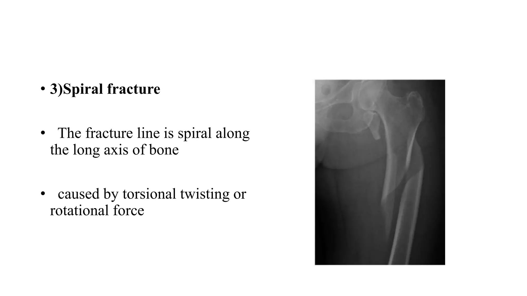 FRACTURE PPT.pptx
