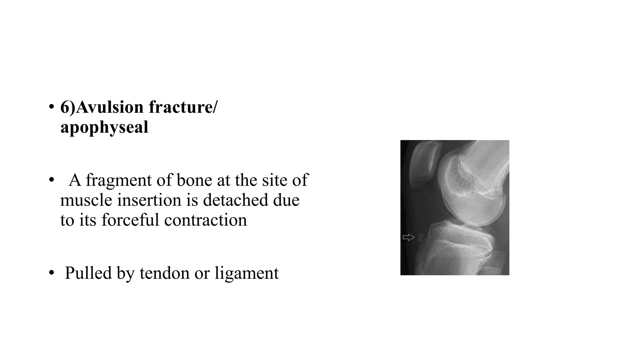 FRACTURE PPT.pptx