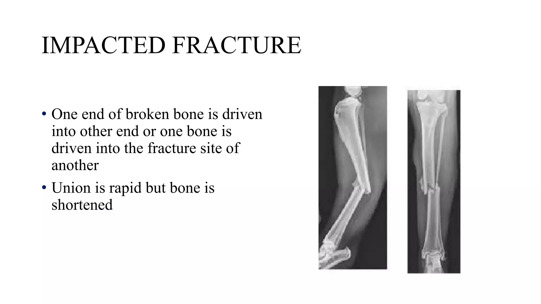 FRACTURE PPT.pptx | Death, Injury, or Military Conflict | Sensitive Topics