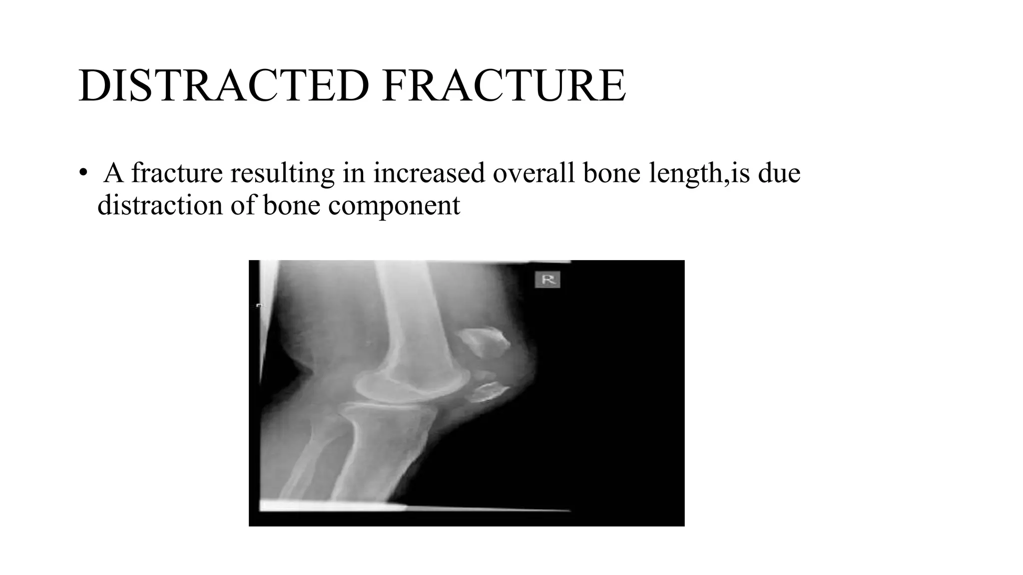 FRACTURE PPT.pptx