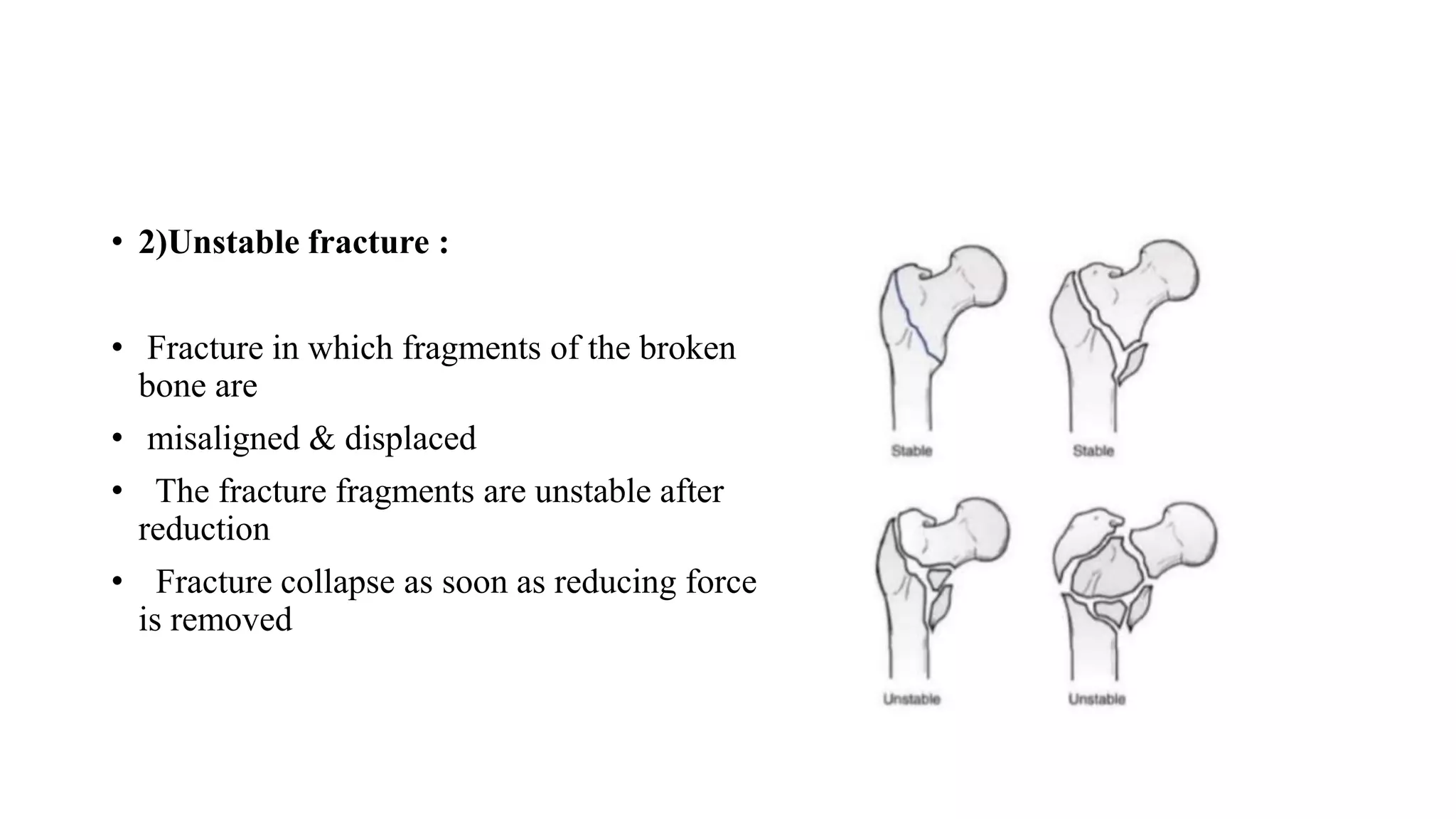 FRACTURE PPT.pptx