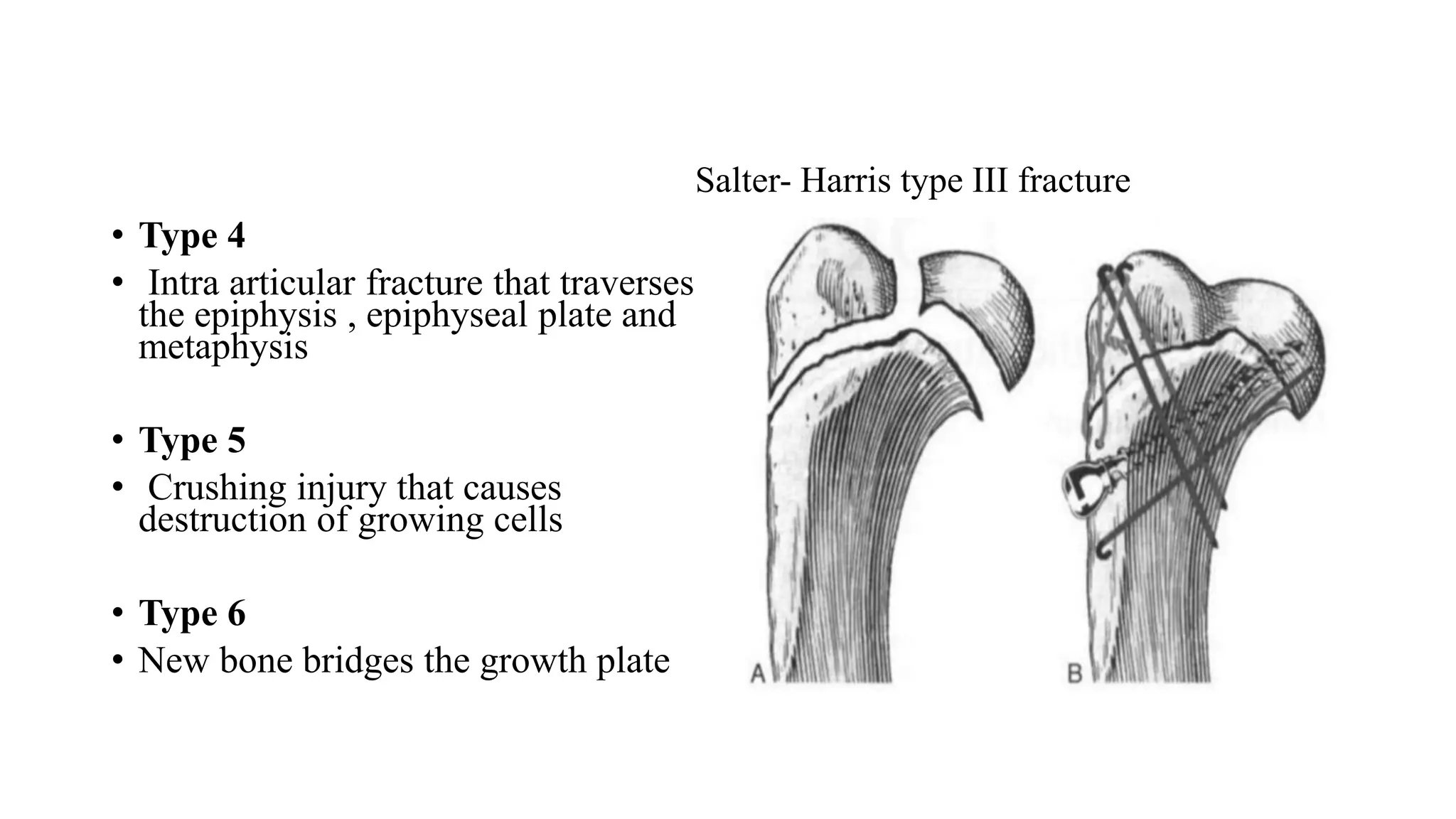 FRACTURE PPT.pptx