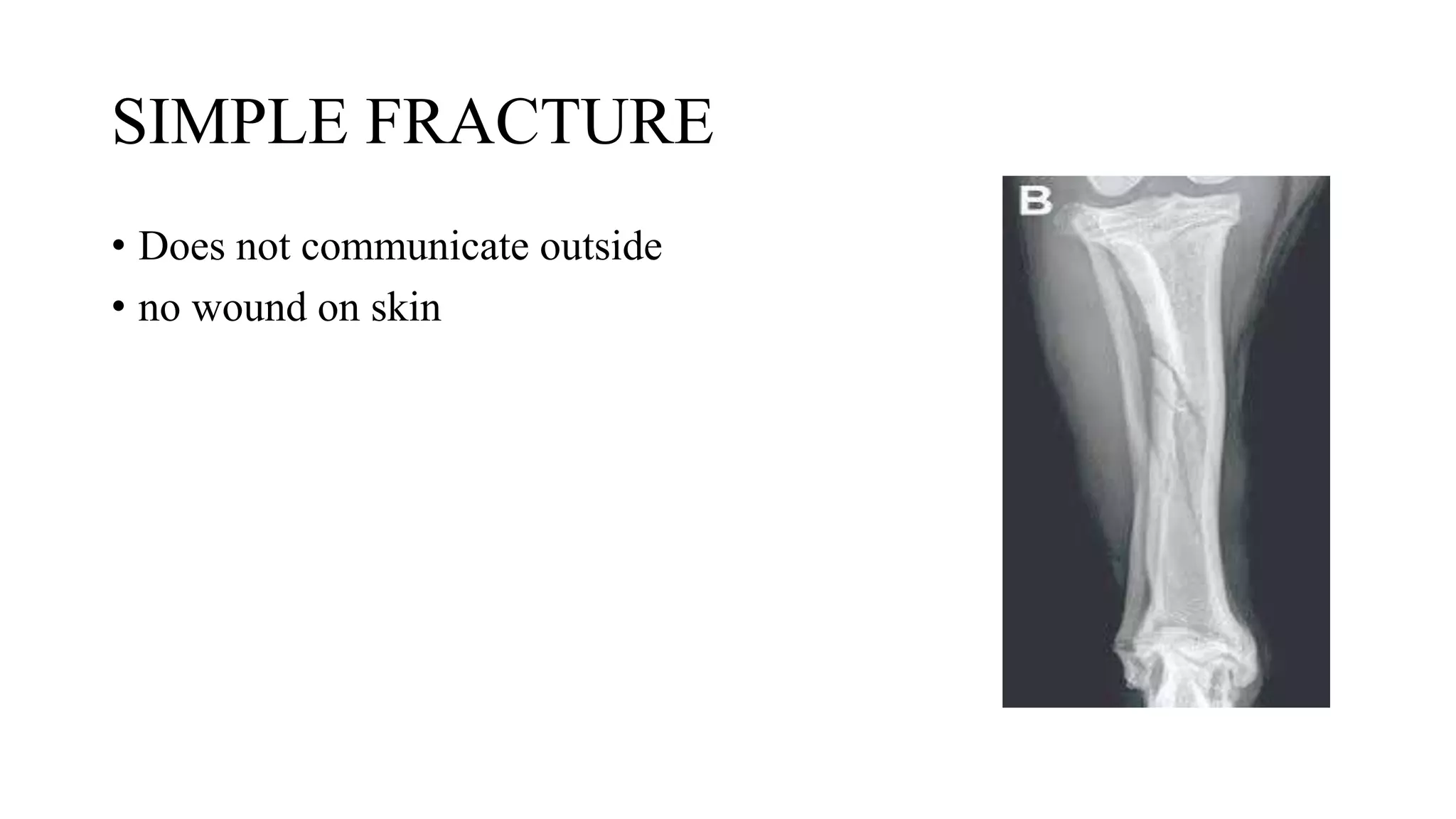 FRACTURE PPT.pptx