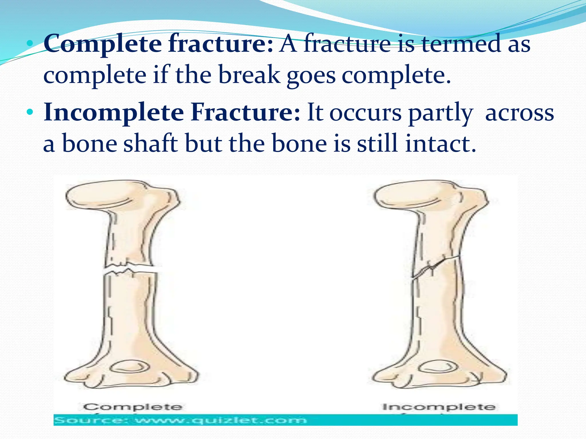 FRACTURE PPT.pptx