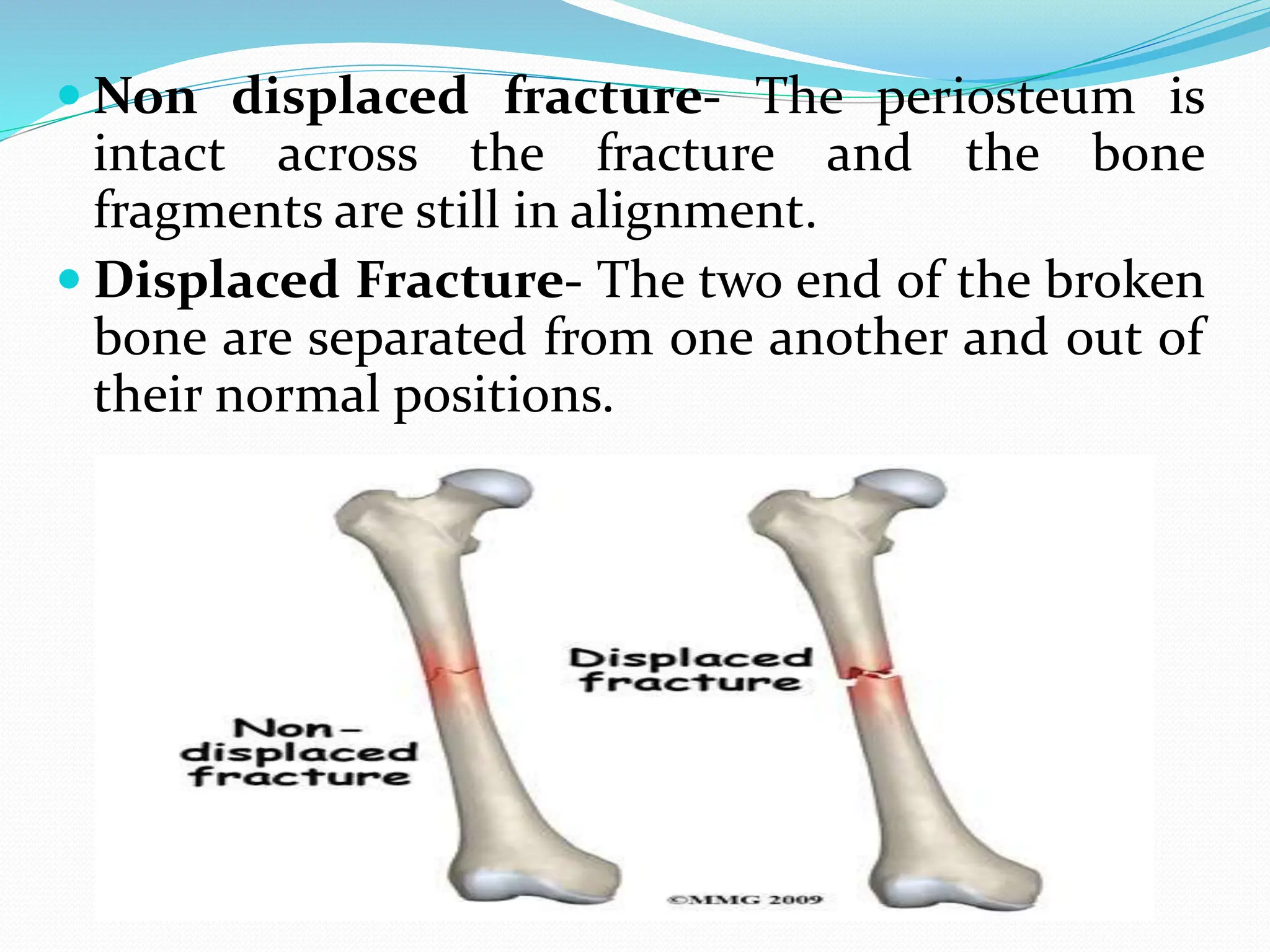 FRACTURE PPT.pptx