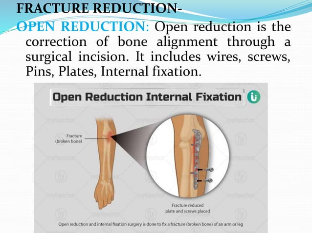 FRACTURE PPT.pptx