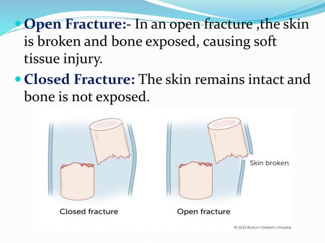 FRACTURE PPT.pptx