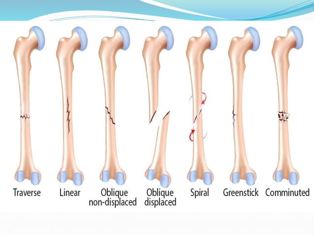 FRACTURE PPT.pptx