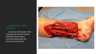 Basic anatomy of Bone , Fracture and Healing | PPTX