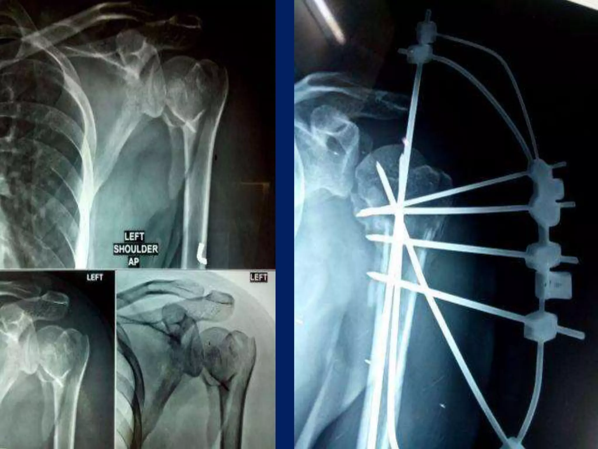 Fracture Proximal Humerus Fixation With K Wires And External Fixator Pptx