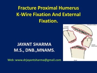 Fracture proximal humerus Fixation with K wires and External fixator | PPTX
