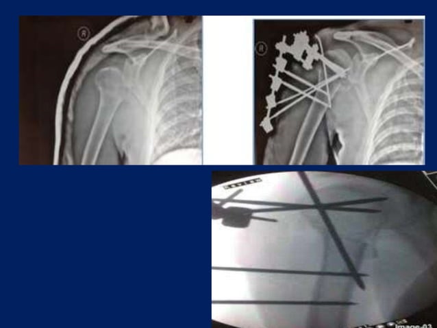 Fracture proximal humerus Fixation with K wires and External fixator | PPTX