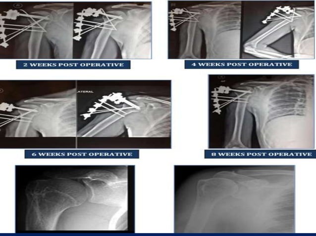 Fracture Proximal Humerus Fixation With K Wires And External Fixator Pptx