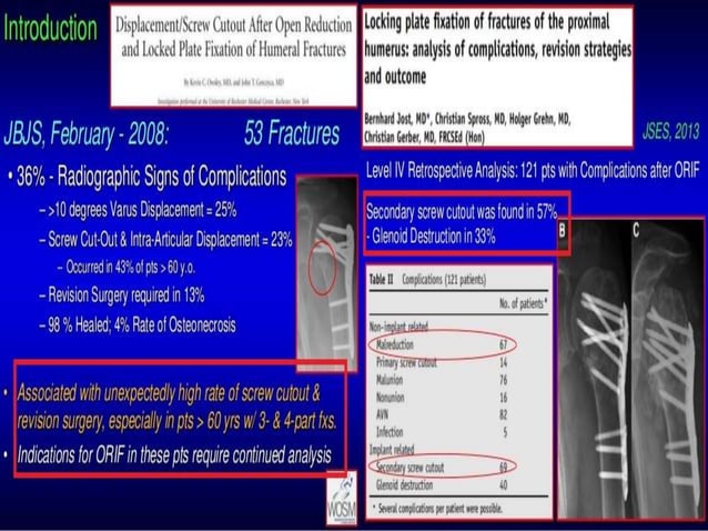 Fracture proximal humerus Fixation with K wires and External fixator | PPTX
