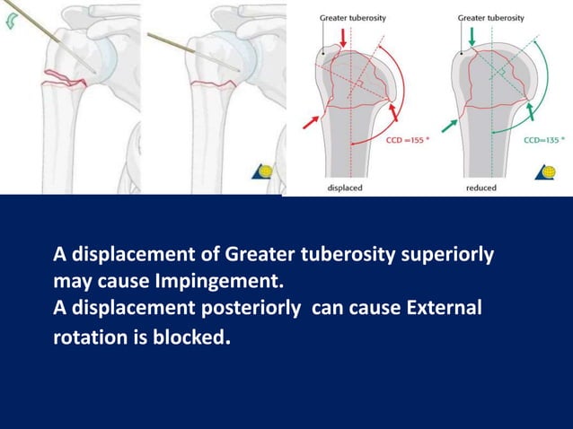 Fracture proximal humerus Fixation with K wires and External fixator