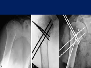 Fracture proximal humerus Fixation with K wires and External fixator | PPT