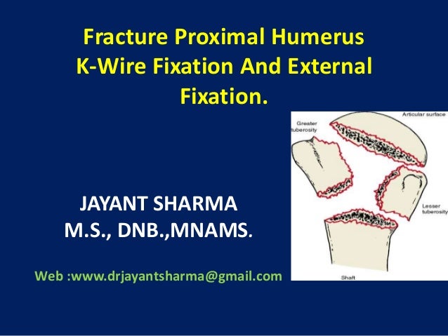 Fracture proximal humerus Fixation with K wires and External fixator