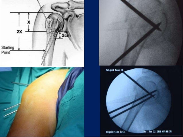 Fracture Proximal Humerus Fixation With K Wires And External Fixator