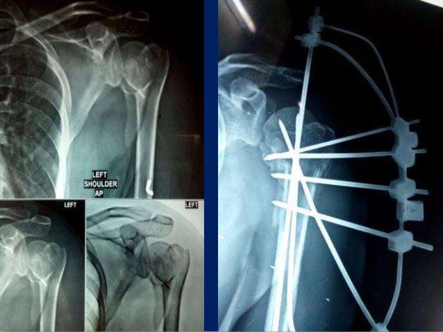 Fracture proximal humerus Fixation with K wires and External fixator