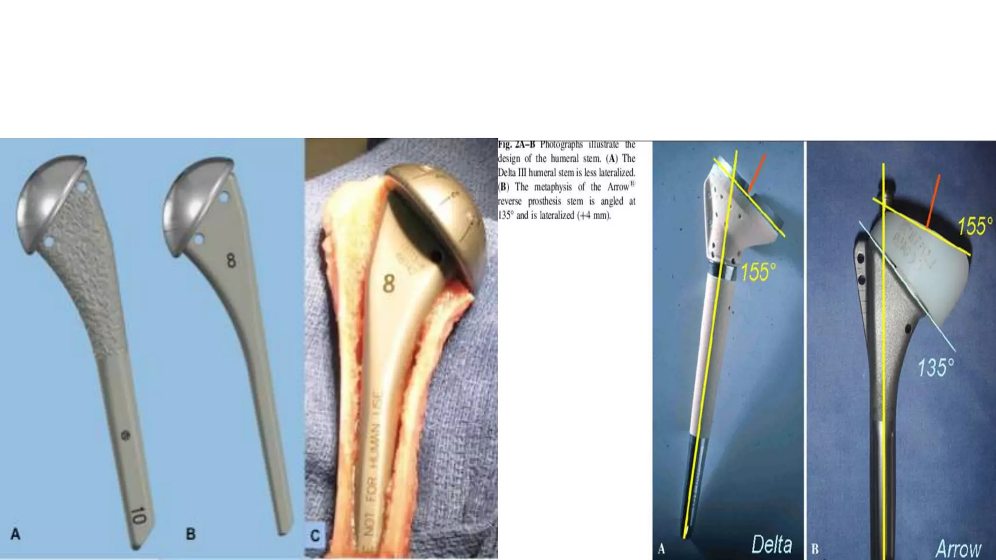 Fracture proximal humerus | PPTX
