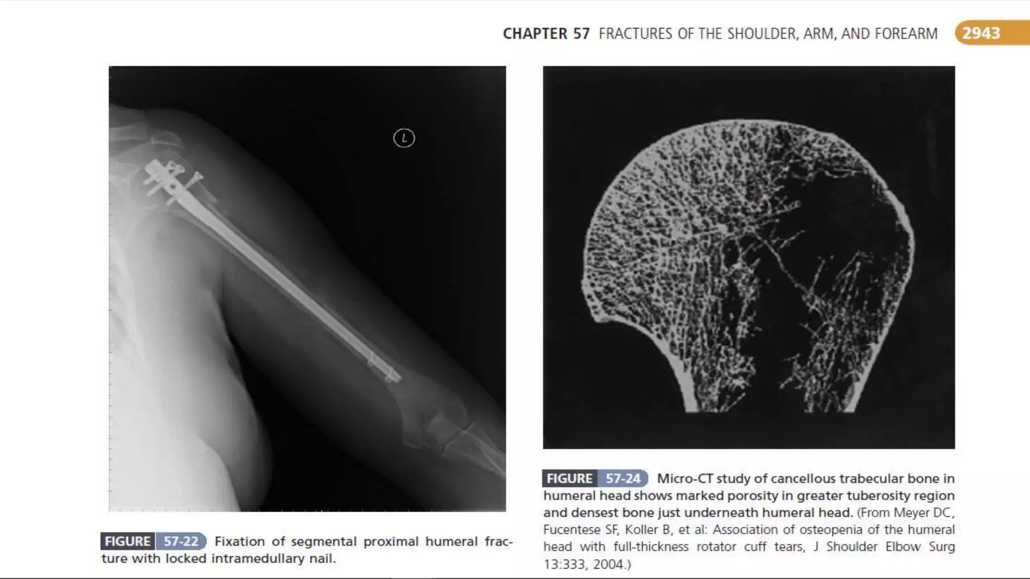 Fracture proximal humerus | PPTX