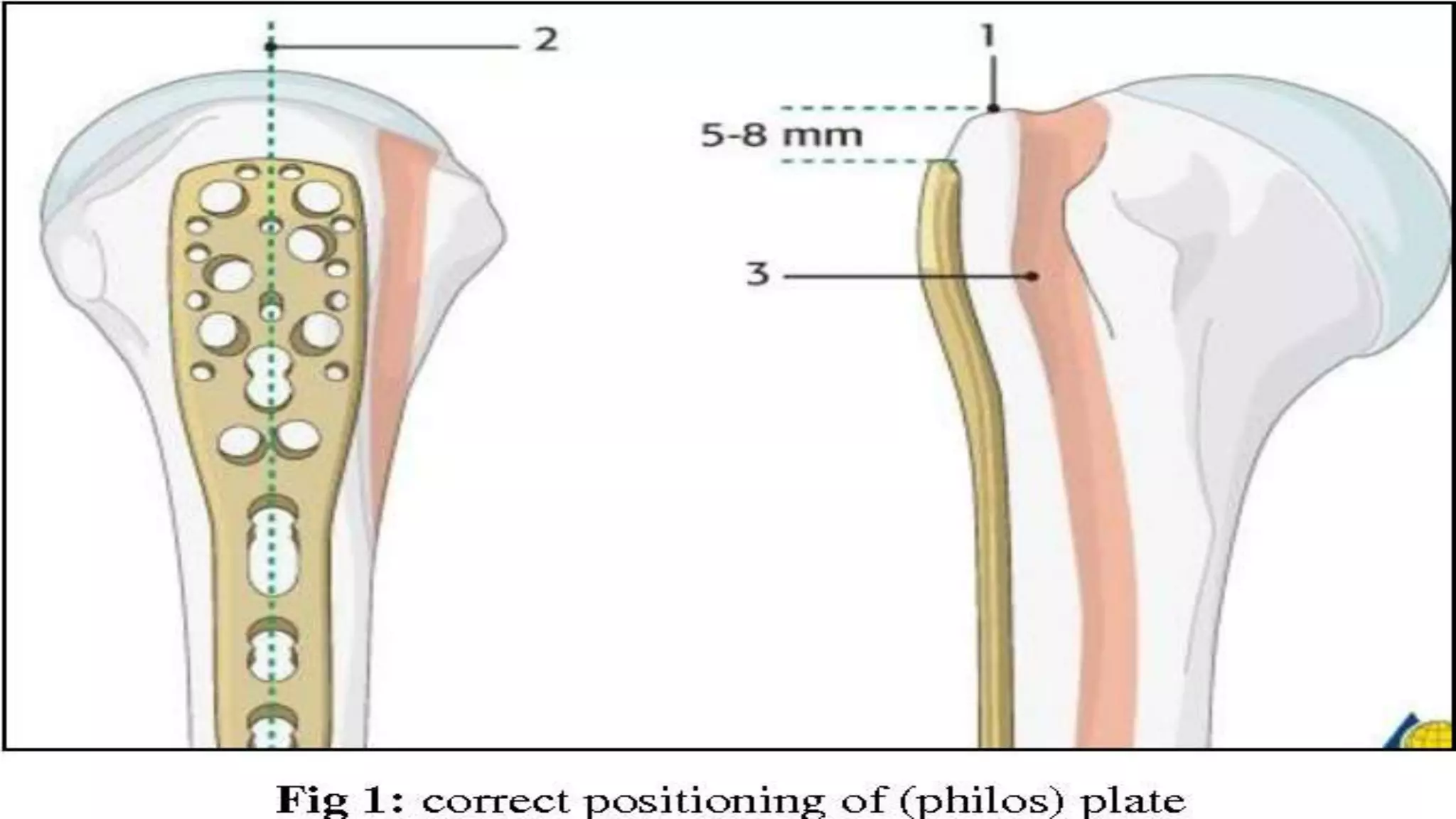 Fracture proximal humerus | PPTX