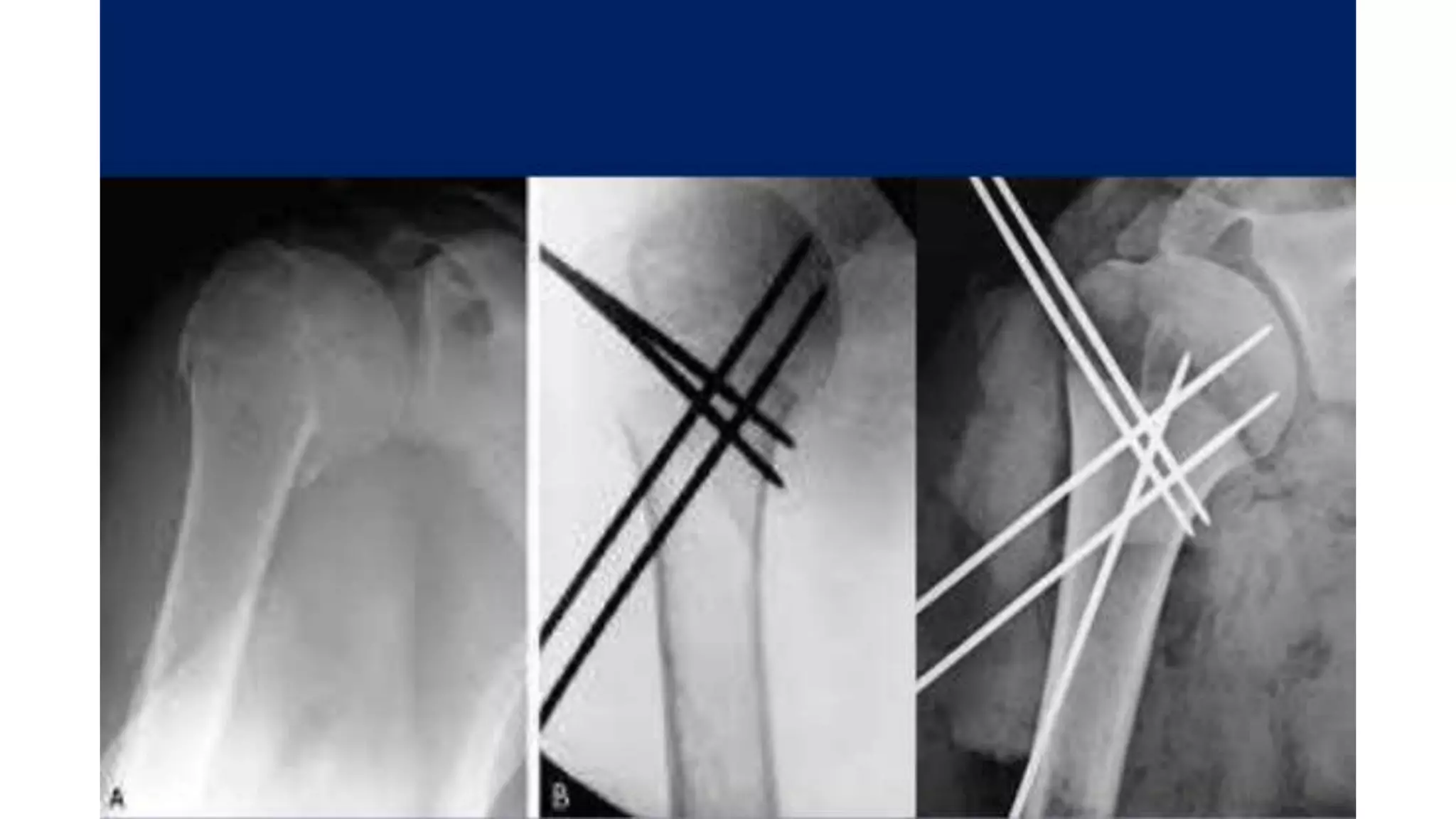 Fracture proximal humerus | PPTX