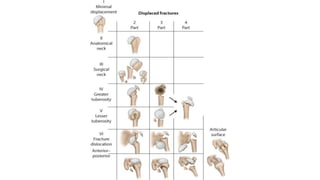 Fracture proximal humerus | PPTX