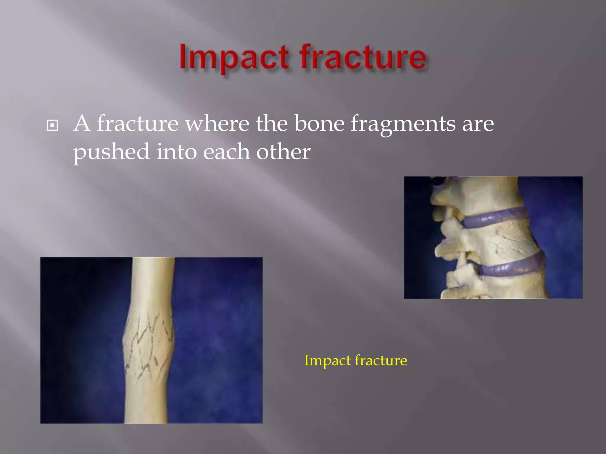 Fracture ppt | PPTX