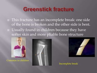 Fracture ppt | PPTX