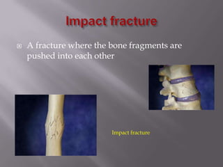 Fracture ppt | PPTX