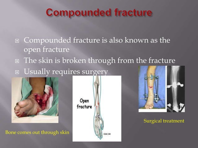 Fracture ppt | PPTX