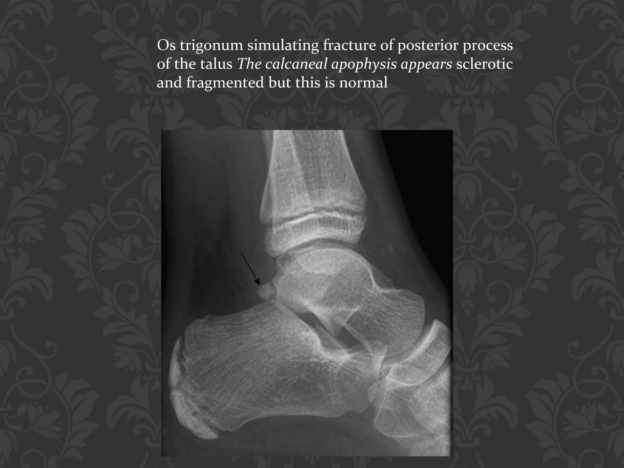 FRACTURE REPORTING TECHNIQUES FOR MEDICOS | PPT